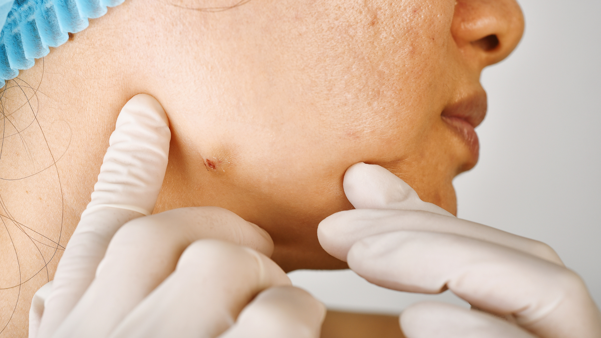 Jerawat Batu: Penyebab, Pengobatan, dan Pencegahannya - GRIN Astra Komponen Indonesia